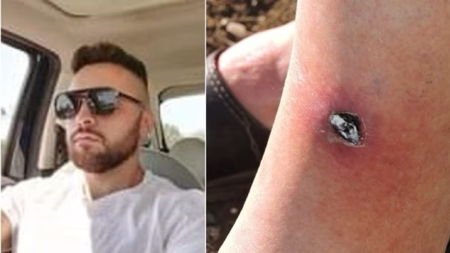 Italia, muore a 23 anni per il morso di un ragno violino: shock settico ...