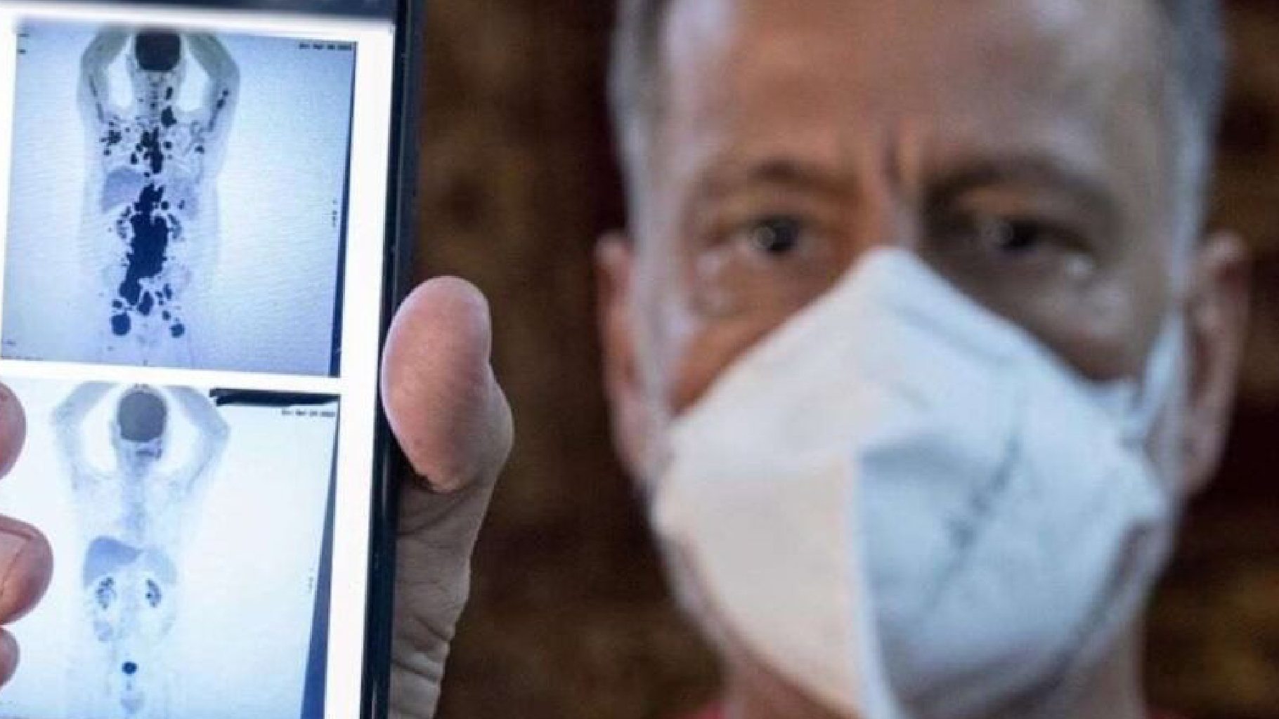 Il cancro è scomparso Malato terminale guarisce dal tumore il risultato ...