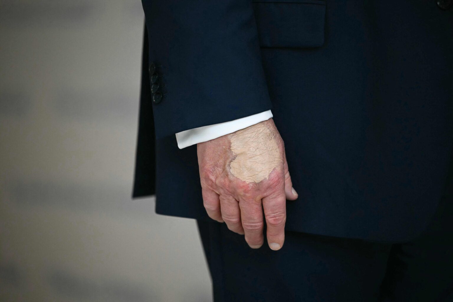 Il livido sulla mano di Trump cosa significa? Quali problemi di salute ...