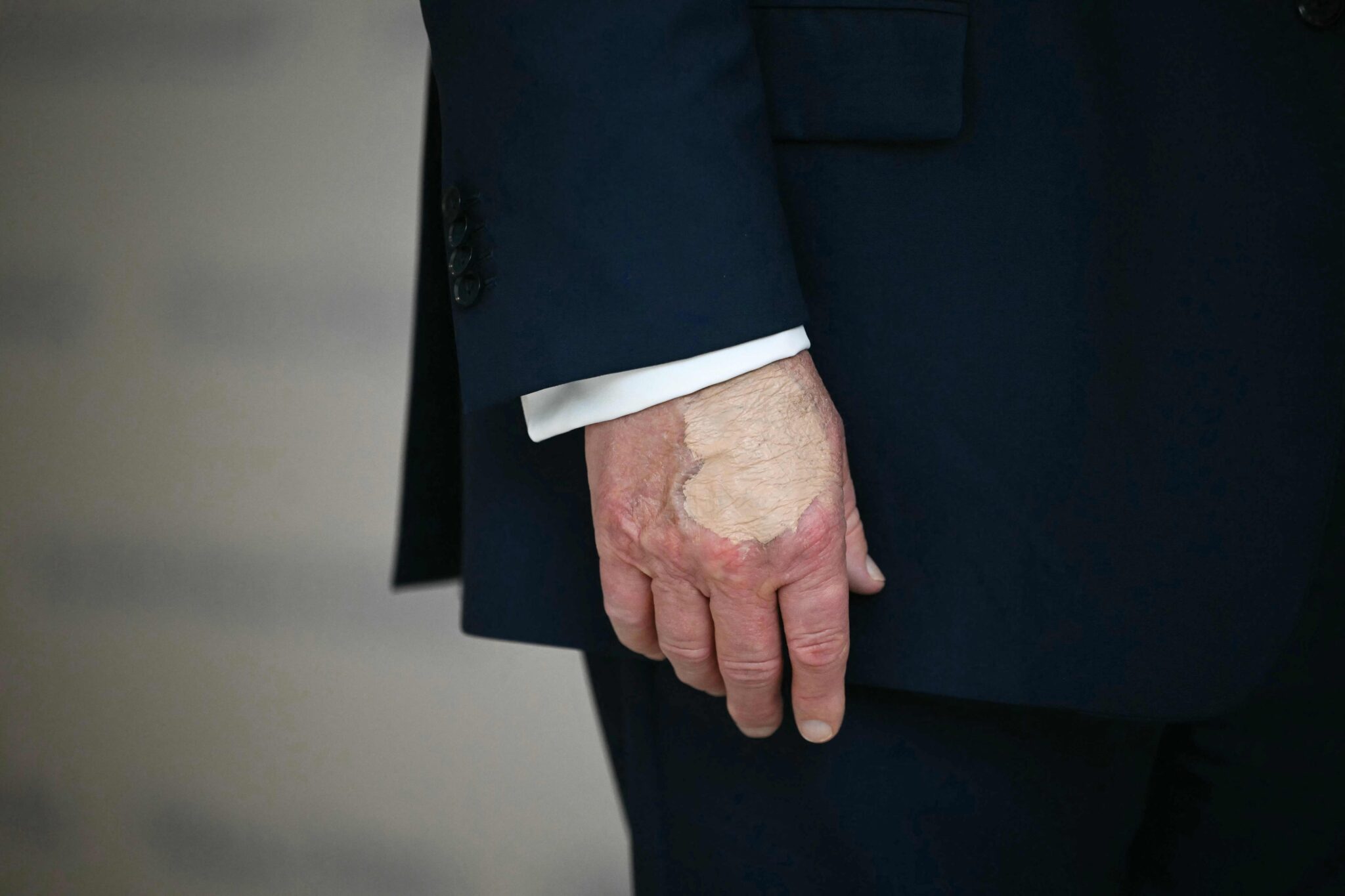 Il livido sulla mano di Trump cosa significa? Quali problemi di salute ...